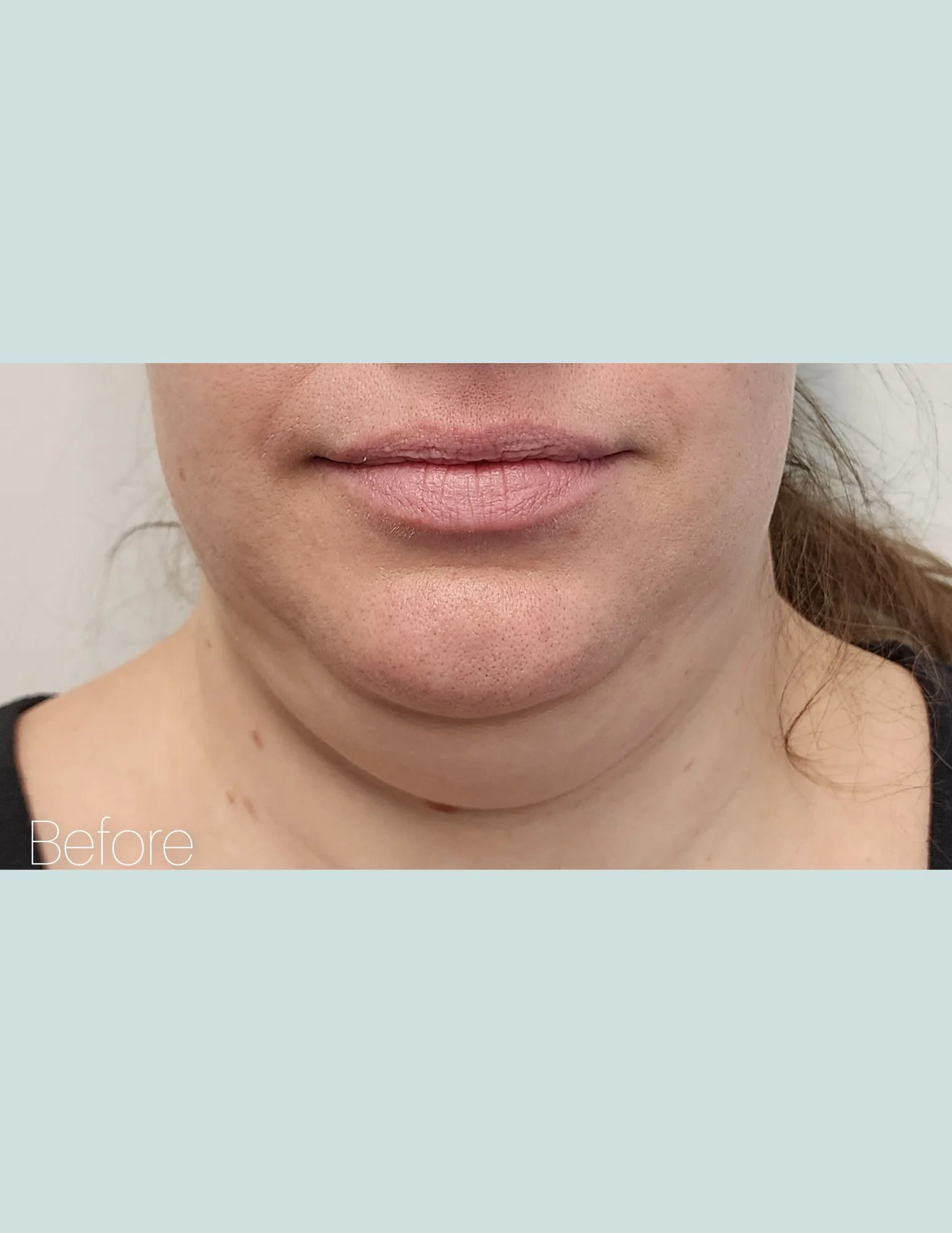 Medical Aesthetics Clinic Limoges ON | Ottawa | Embrun